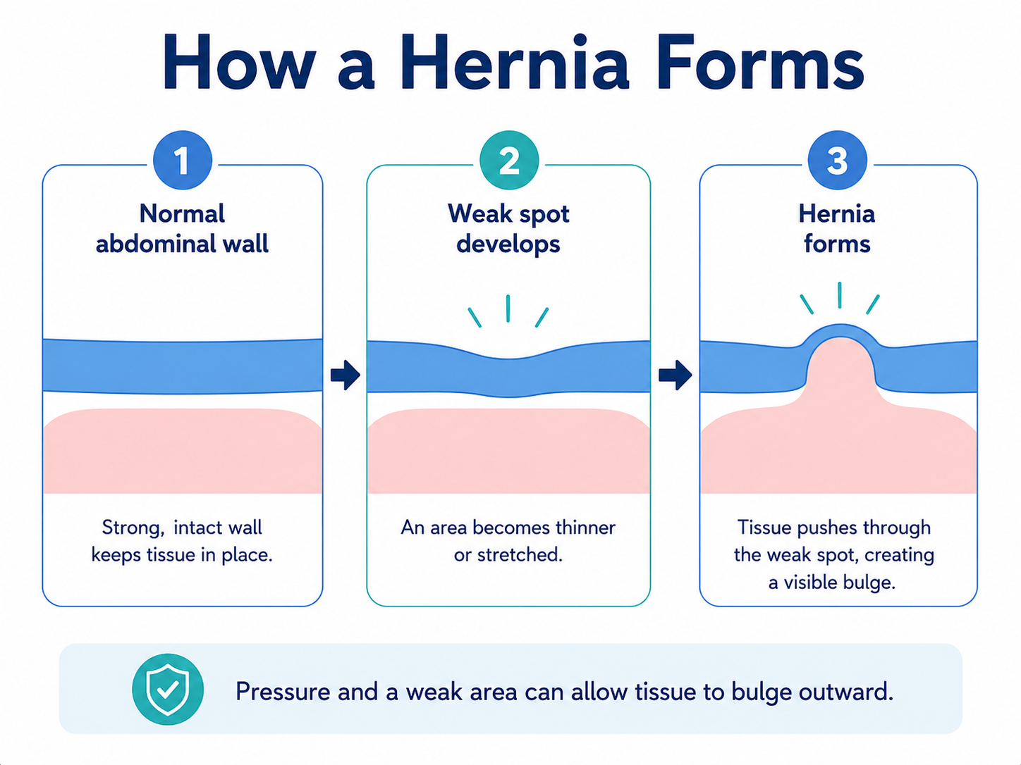 Why Hernias Are More Common in Men | Surgical Services of Athens